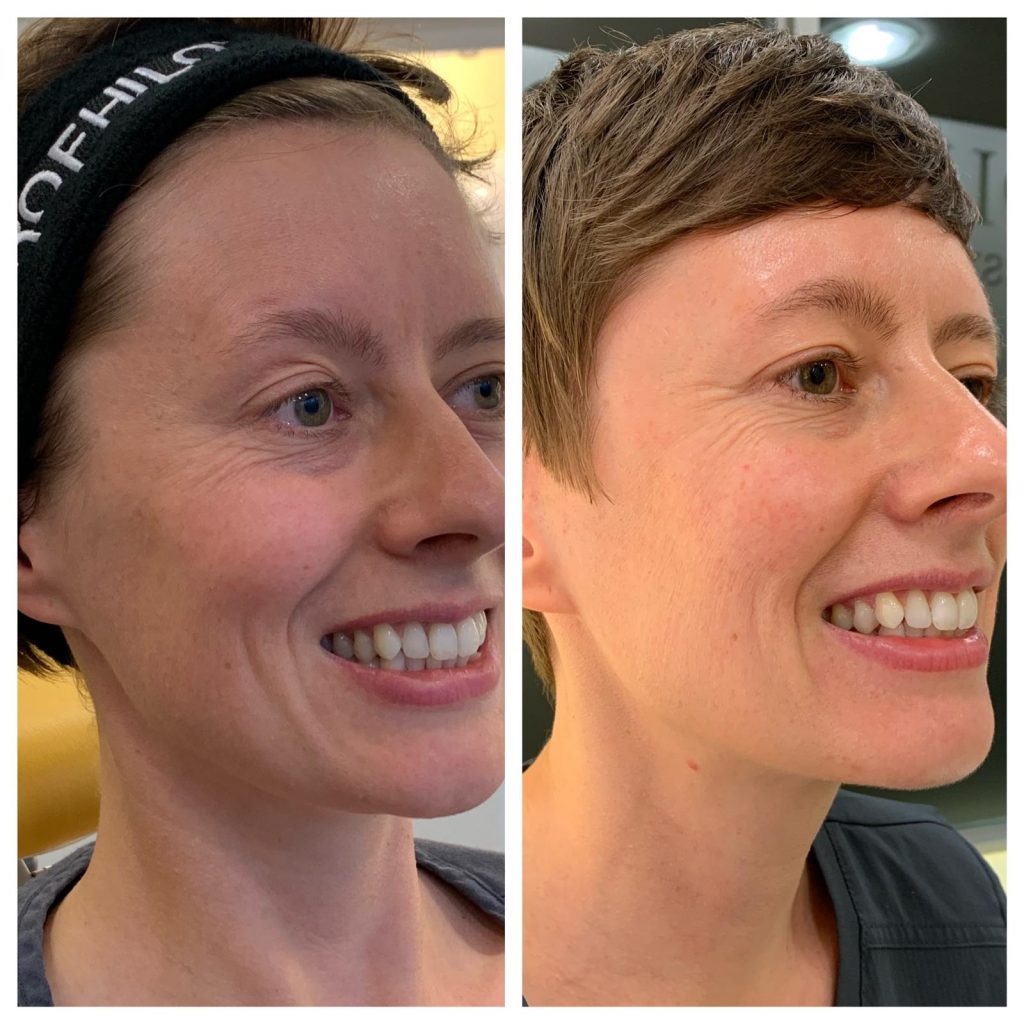 Profhilo in Portishead | Injectable Fillers at Evolve Dentistry, Somerset